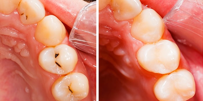 Wie lange nach einer Füllung darf ich Zähne putzen? Kurze und einfache ...